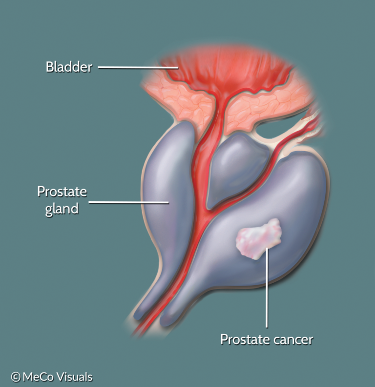 Prostate Cancer Staging | Prostate Cancer Foundation